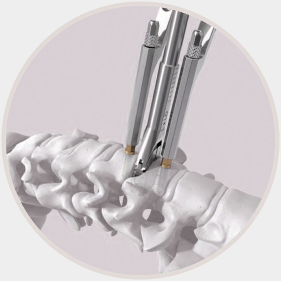 Centinel Spine | For prodisc® Motion-Preservation/Disc Arthroplasty and ...