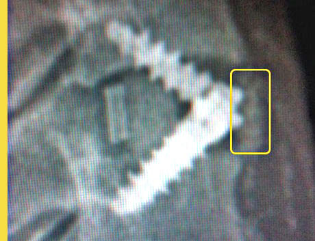 Centinel Spine | For prodisc® Motion-Preservation/Disc Arthroplasty and ...